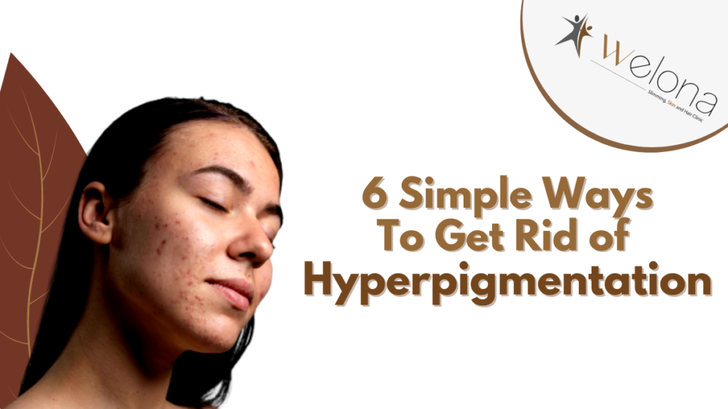 Top Ways to Get Rid of Hyperpigmentation - Welona