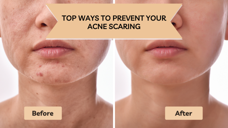 Top Ways to Prevent Acne Scarring - Welona