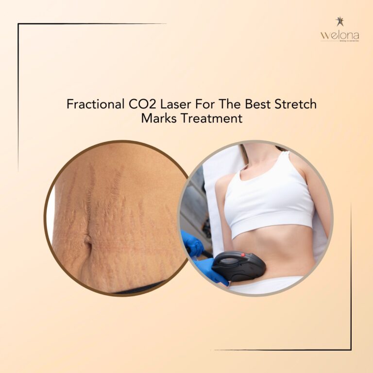 Fractional CO2 Laser For The Best Stretch Marks Treatment - Welona