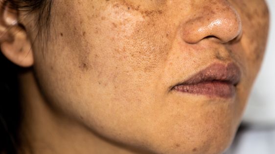 Understanding hyperpigmentation: Causes, Prevention and Treatment ...