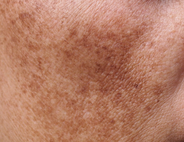 Melasma vs. Hyperpigmentation: What's the Difference? - Welona